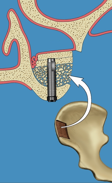 Wat is een botopbouw? - Kaakchirurgie Zeeland